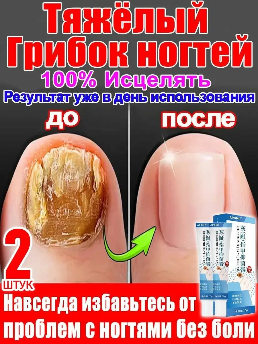 2 штуки, крем ноготок от грибка ногтей на ногах, ноготок мазь от грибка на ногах, гиперкератоз