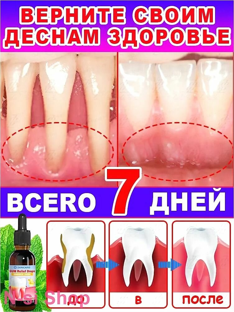 Используется для лечения пародонтита, стоматита, снятия чувствительности и отека десен, восстановления, профилактики и укрепления поврежденных десен, Гигиена полости рта.30 мл.