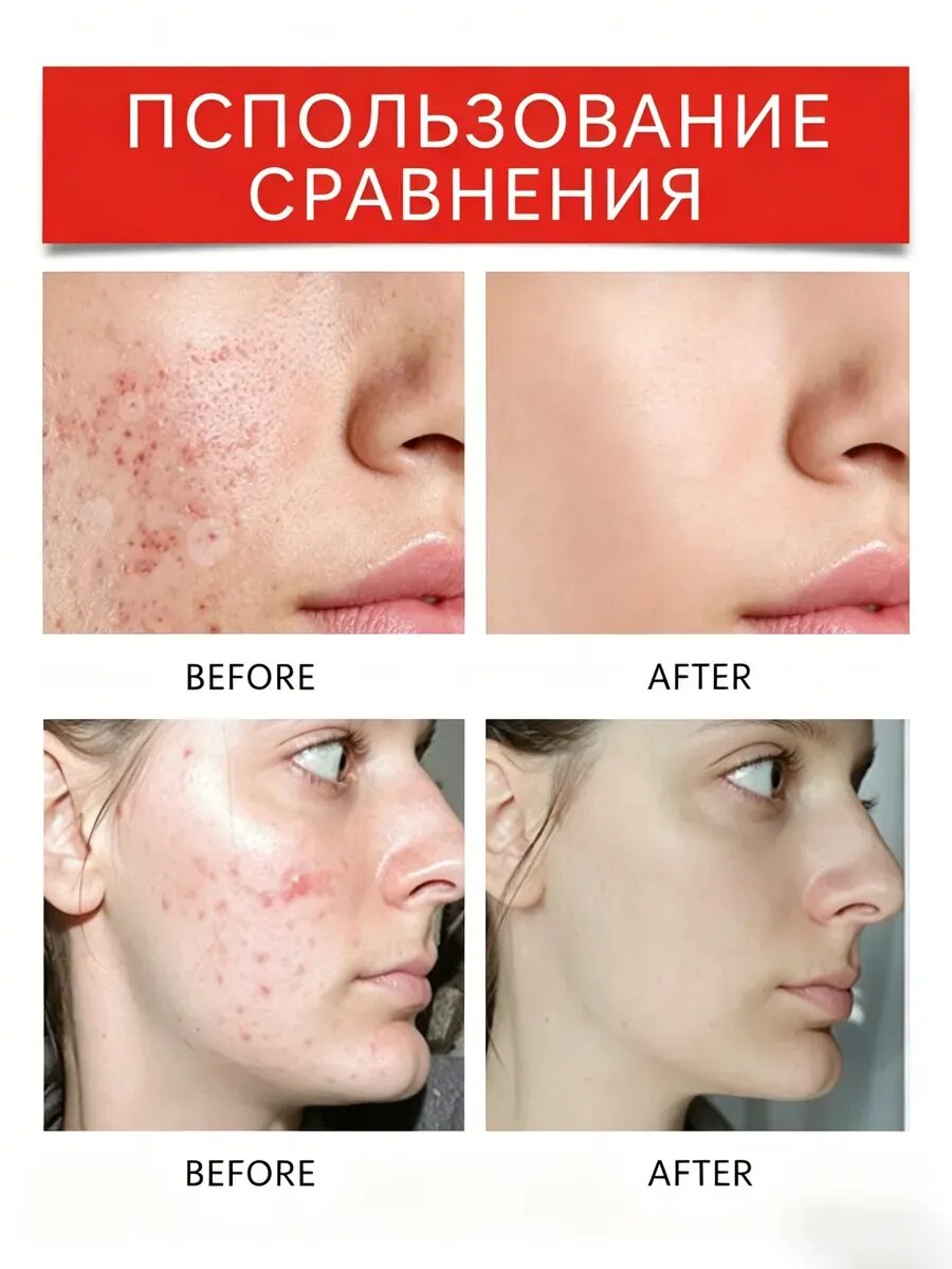 Патчи от прыщей, Глубоко увлажняет, ускоряет исчезновение угревой сыпи, снимает покраснения и отеки 240шт. — фото 1