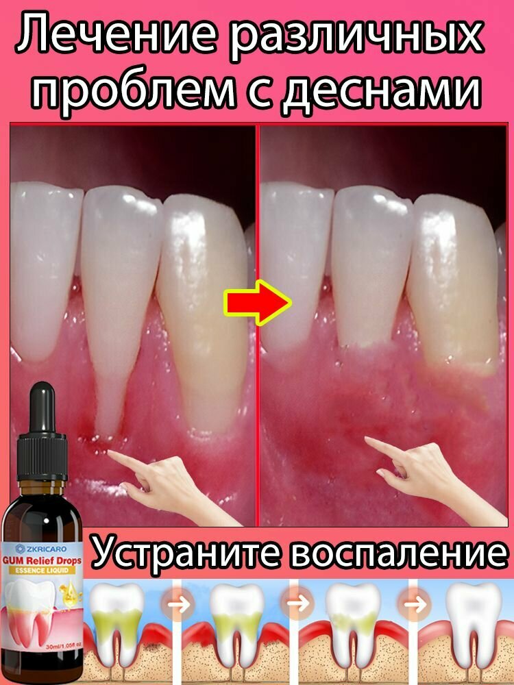 Используется для лечения пародонтита, стоматита, снятия чувствительности и отека десен, восстановления, профилактики и укрепления поврежденных десен, Гигиена полости рта.30 мл.