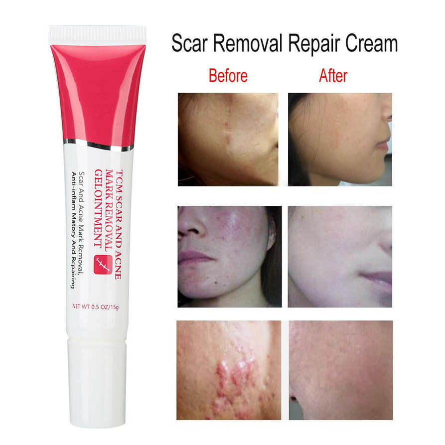 15 г Крем для удаления шрамов, гель для восстановления кожи, темных пятен на лице и теле