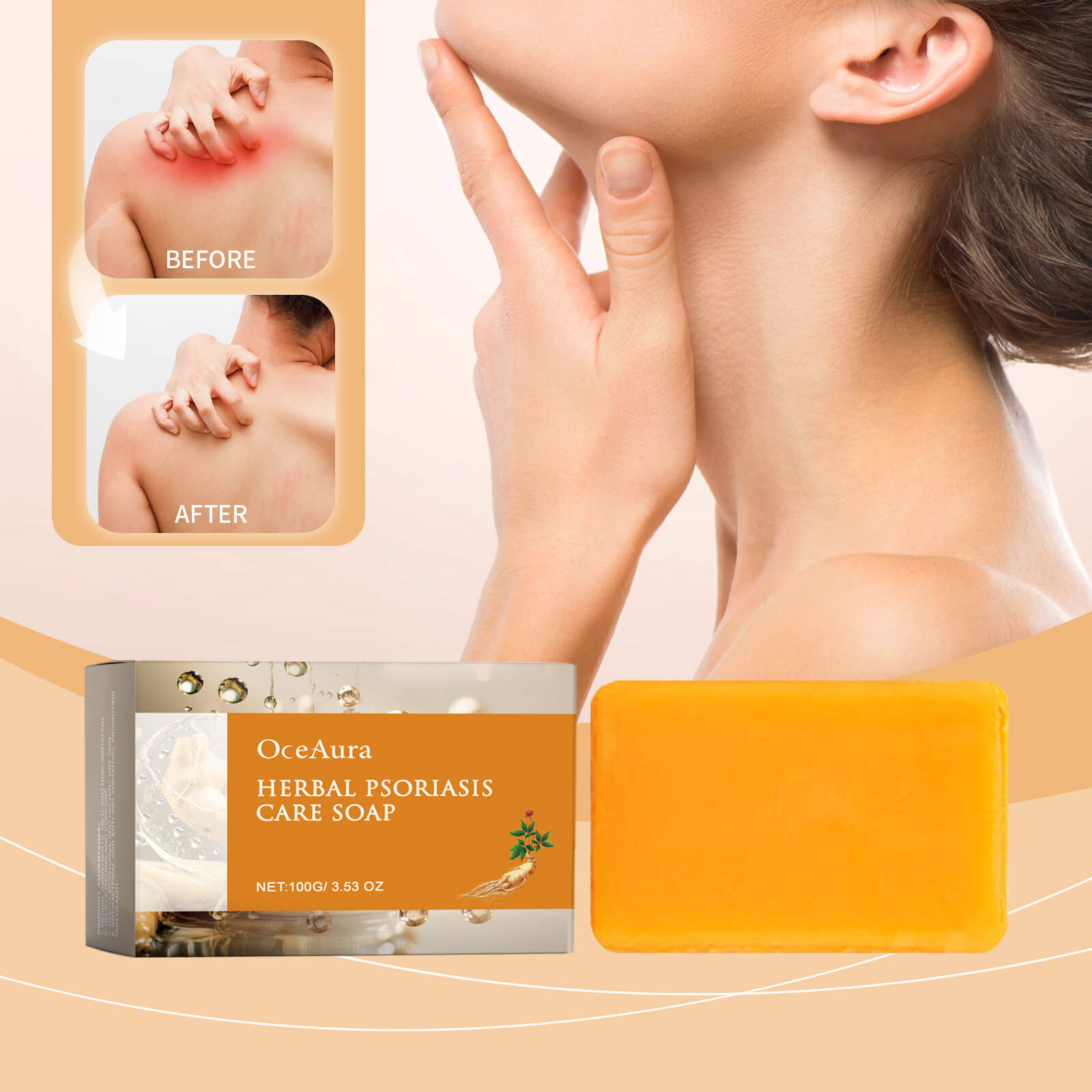 Мыло для ухода за псориазом снимает кожный дискомфорт, увлажняет кожу и охлаждает ее