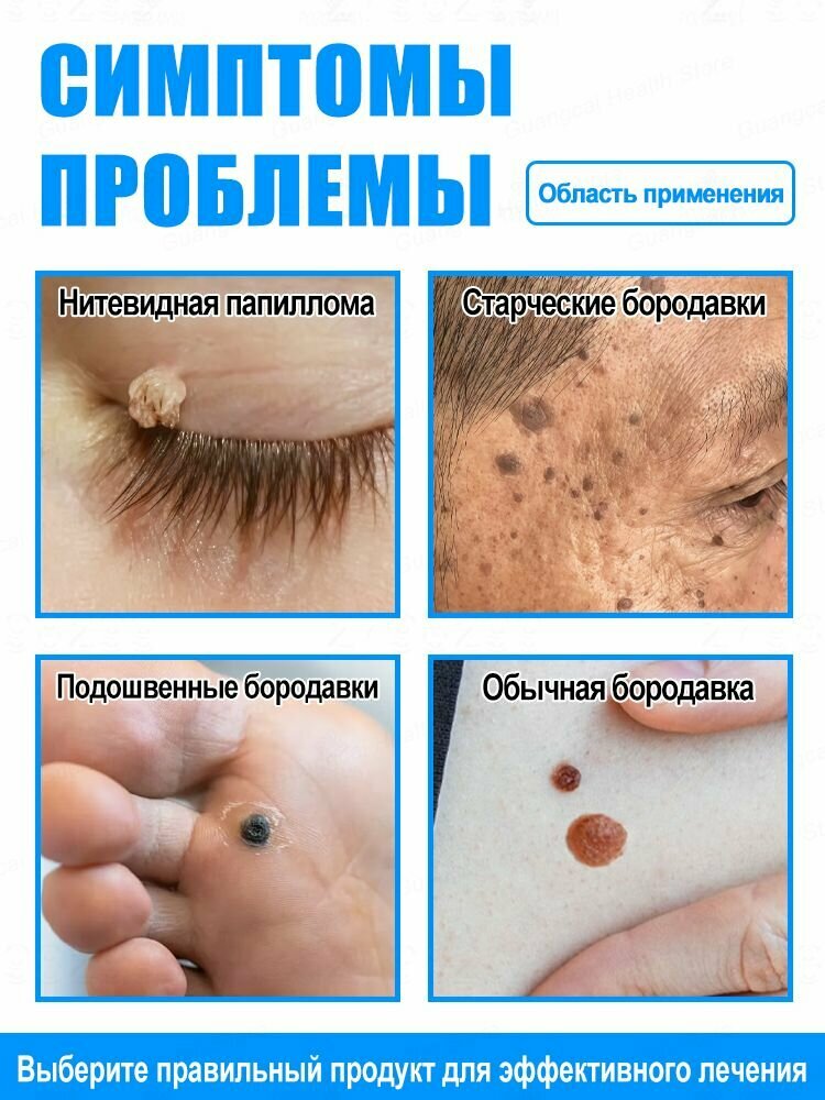 Лазерное удаление бородавок. С его помощью можно удалять различные бородавки, родинки, папилломы и остроконечные кондиломы. Безопасно, без шрамов, боли и побочных эффектов.1 ручка.