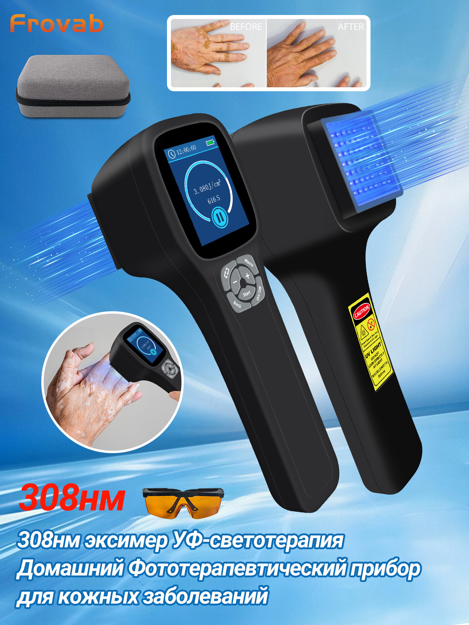 Портативный УФ облучатель Frovab 308нм 49 диода, использование дома, терапия кожных болезней взрослых разных стадий