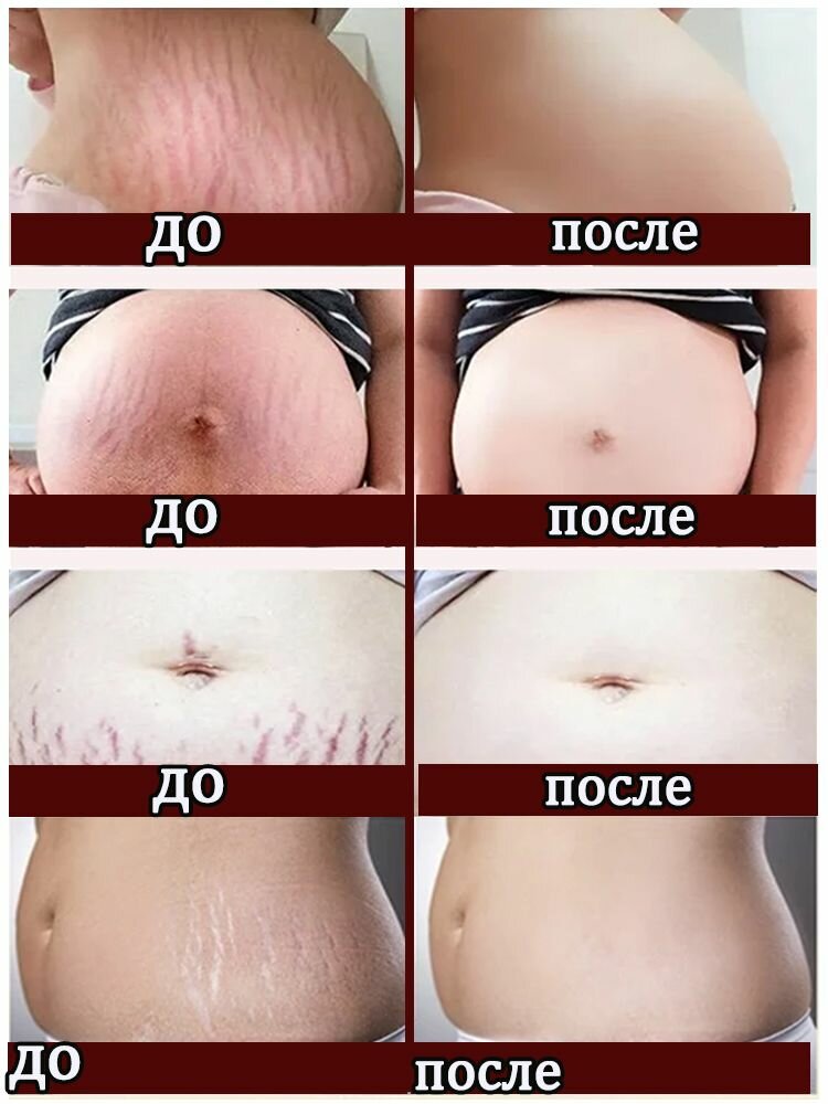 Крем от шрамов и рубцов, следов от акне, растяжек, ожогов и послеоперационных шрамов, натуральный состав, предотвращает образование рубцов, восстанавливает кожу, 50 г