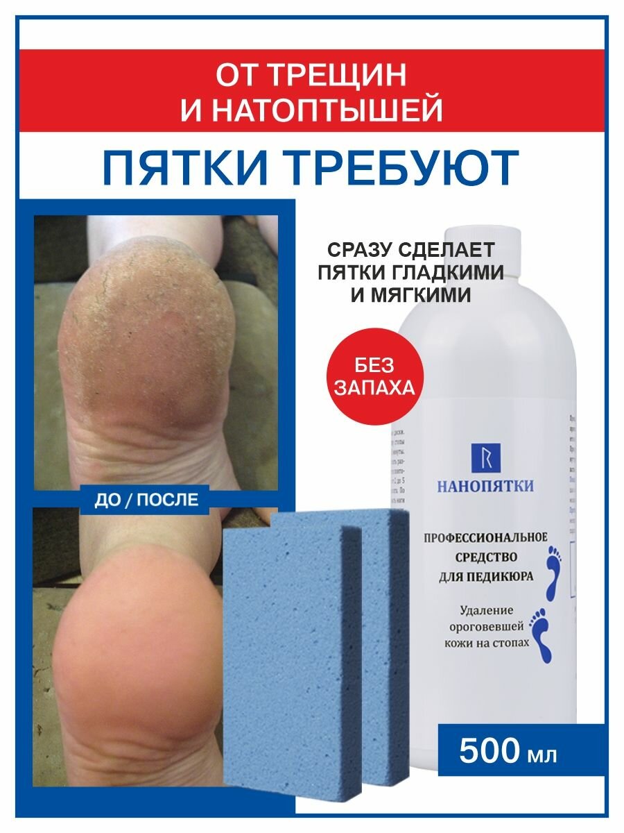 Нанопятки средство от натоптышей на ногах, кератолитик для пяток от трещин и сухих мозолей, жидкое лезвие для педикюра 500 мл, пемза косметическая 2 шт