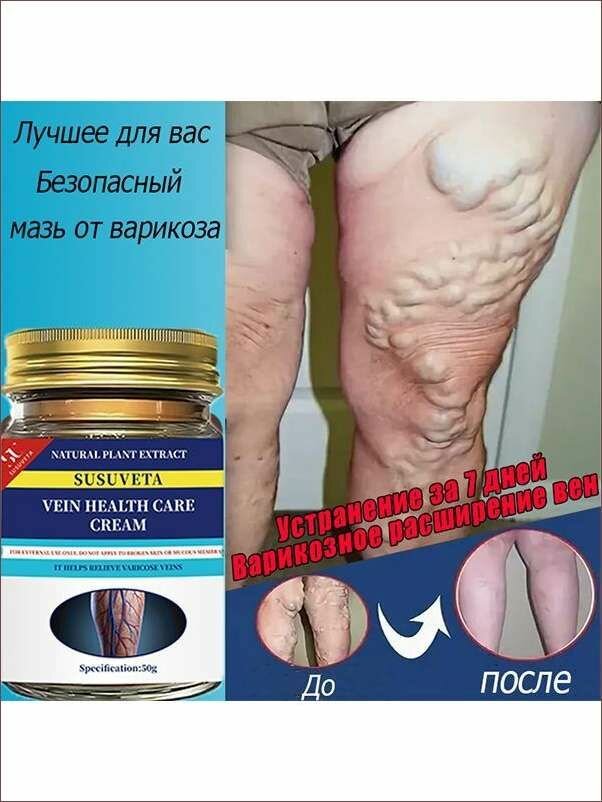 Крем от варикоза, для сосудов, отеков и тяжести в ногах, сосудистых звездочек, Эффективен при лечении варикозного расширения вен, 50г