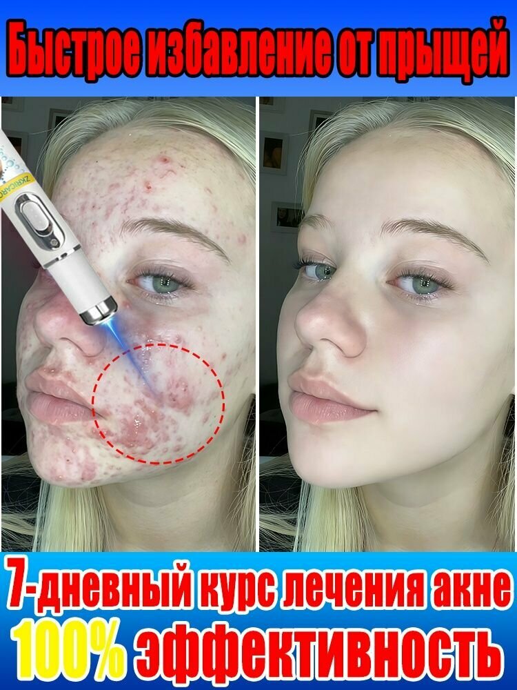 Лазерная указка от прыщей, Подходит для лечения угревой сыпи на лице и теле, Лечение акне, быстрый, Избавиться от прыщей, от черных точек и угрей, безболезненный, Пигментация