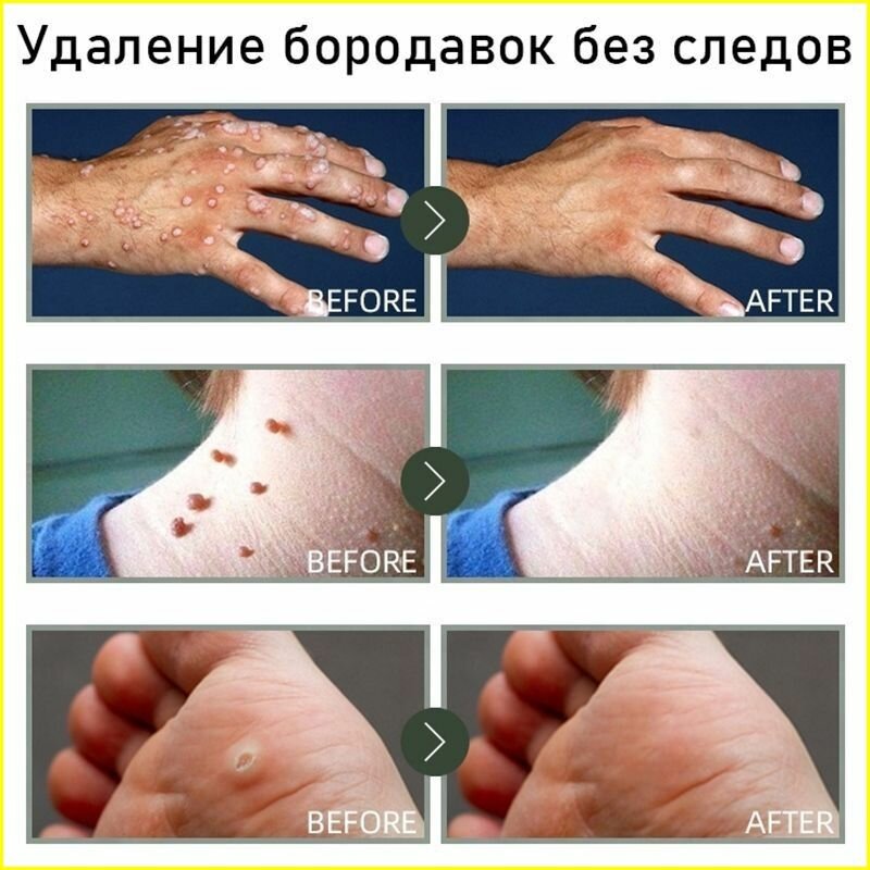Крем от бородавок и папиллом для удаления родинок и кожных наростов без боли с чистотелом