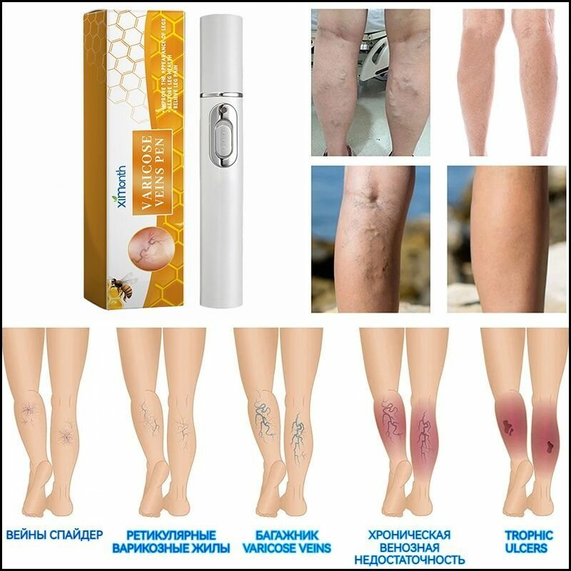 Ручка для лечения варикозного расширения вен, использовать для лечение сосудов, отеков и тяжести в ногах, сосудистых звездочек, тромбоза