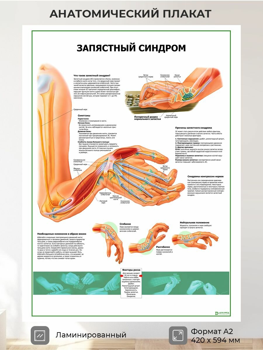 Обучающий медицинский плакат ламинированный формат А2 Запястный синдром