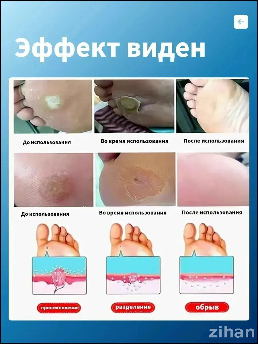 Средство от шипиц, натоптышей и сухих стержневых мозолей на ногах мазь и гель Корнекс, эффективное китайское средство