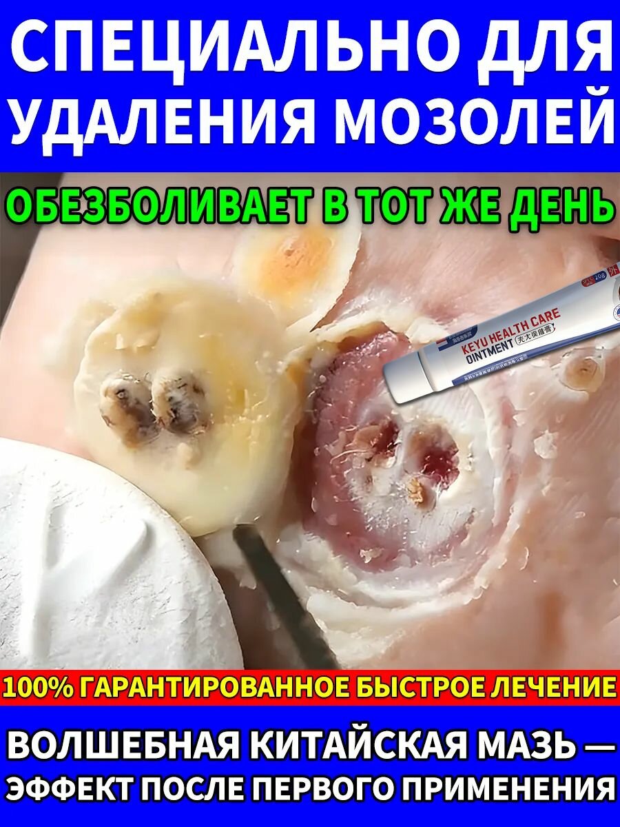 Китайский Мазь от мозолей стержневых, колломак от бородавок, салипод от стержневых мозолей, Быстродействующий, Не содержит гормонов, Подходит для лица, шеи, рук, ног, ступней и всего тела.