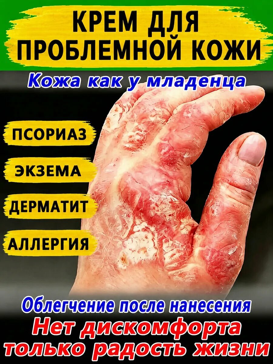 Крем от псориаза дерматита экземы и зуда кожи