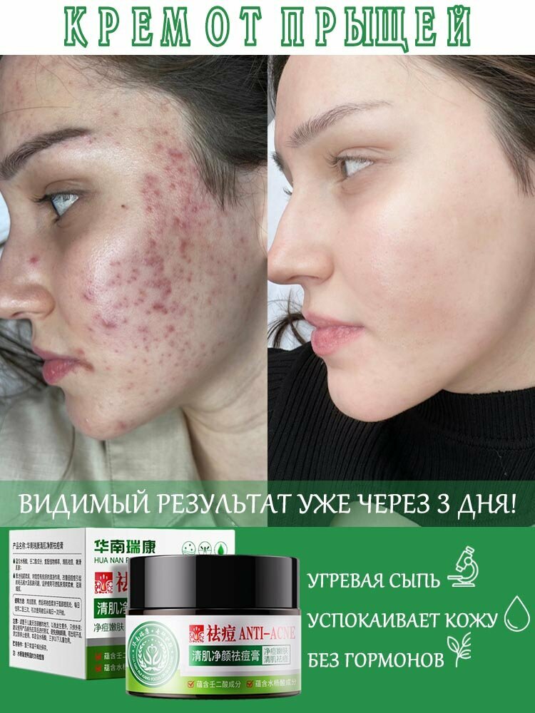 Крем от прыщей на лице, против акне, 30г