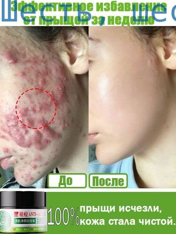 Салициловая мазь от прыщей, направленная на акне и угри, эффективно борется с воспалениями, прыщами и последствиями акне, подходит подросткам и проблемной коже, 30 г.