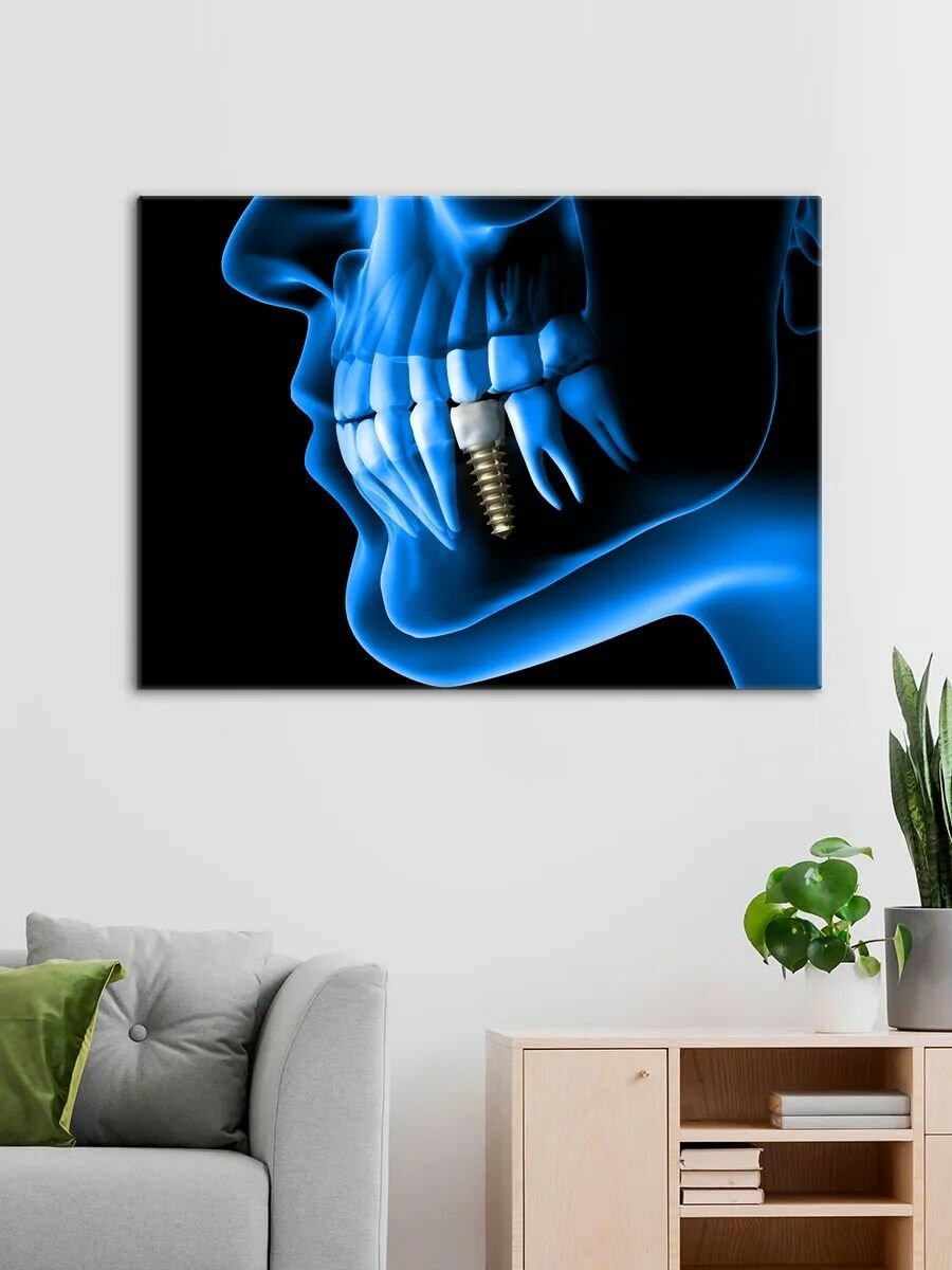 Картина на стену "Зубные импланты", 70х50 см