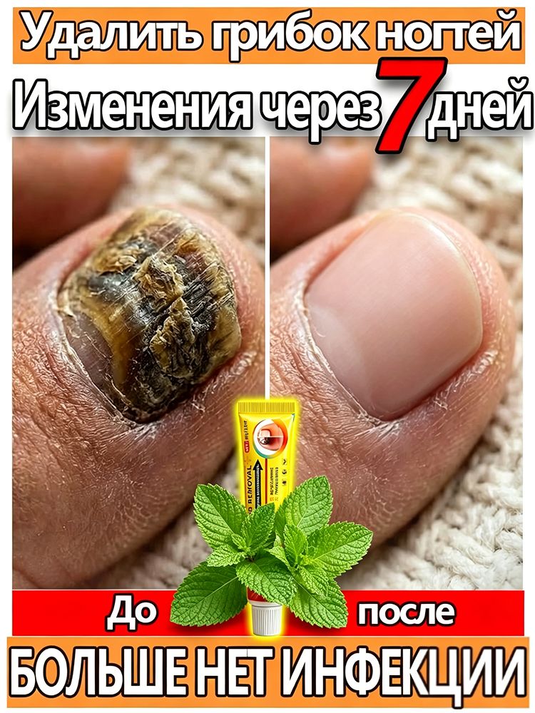 Эта мазь используется для лечения инфекций ногтей и стоп; она уничтожает стойкие грибки, а также восстанавливает и улучшает состояние утолщенных, пожелтевших и ломких ногтей. 30 грамм