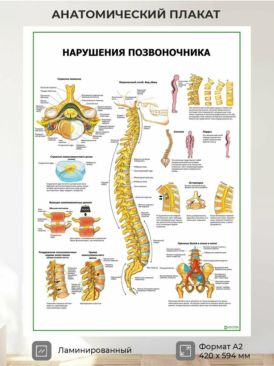 Обучающий медицинский плакат ламинированный формат А2 Нарушения позвоночника