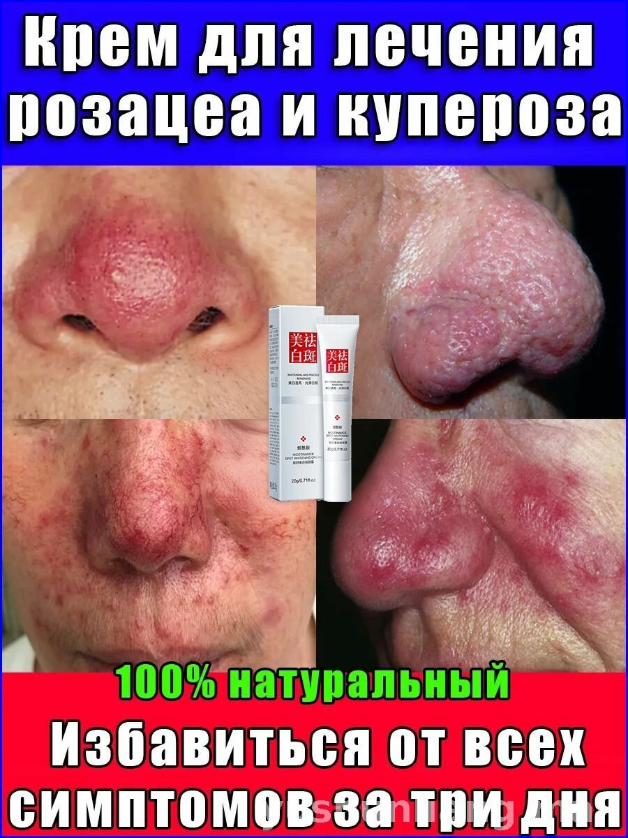 Крем для лица от купероза, розацеа, покраснений "Тонус-Капилляр Лица". для проблемной кожи,100% натуральный В безгормональном составе.20 мл