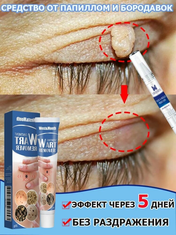 Карандаши для удаления бородавокдля лечения бородавок, средство от папиллом, от бородавок, от мозолей, безболезненный и не вызывающий раздражения / 3 мл