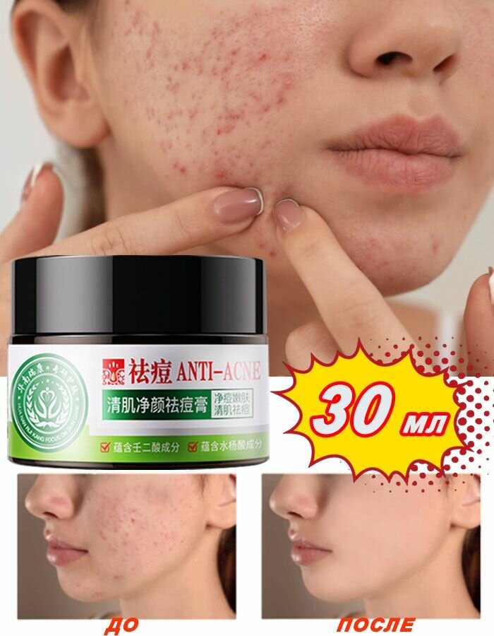 Крем от прыщей для подростков с проблемной кожей, эффективно борется с прыщами, акне, постакне, угрями и черными точками 30 r.YAGUA