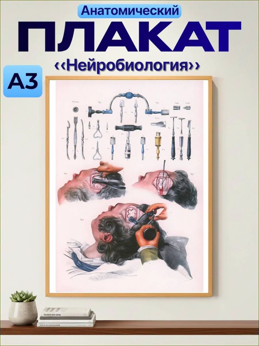 Постер медицинский, трепанация, нейробиология, нейрохирургия, А3 анатомия, хирургия