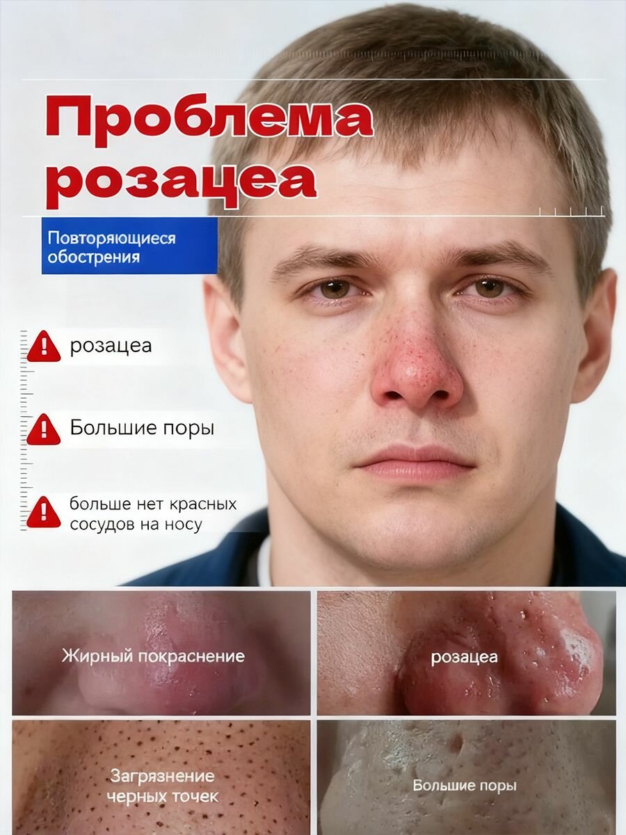 Винная мазь для носа отрозацея и купероза, крем для личения розацеа кожи лица, мазь сосуды носа, Гельтек Гель Демотен Форте от прыщ, крем регенерирующий, 20г