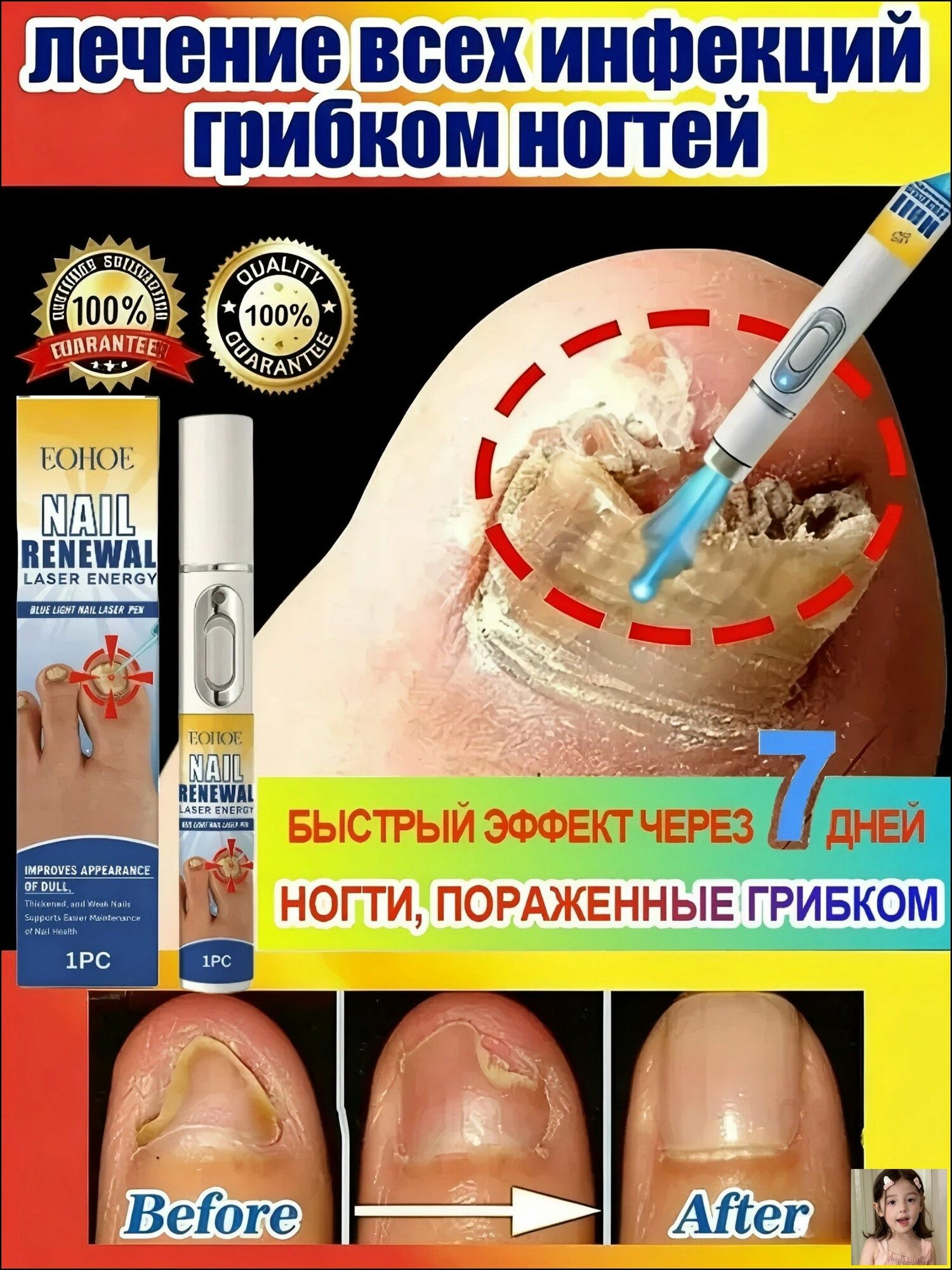 Лазерная ручка для лечения онихомикоза может устранить стойкий онихомикоз за 7 дней, улучшить состояние при паронихии, а также вылечить утолщение ногтей, покраснение, отек, зуд, расслоение и т. д.