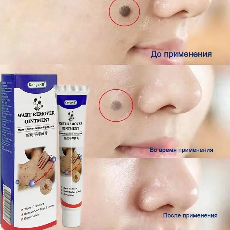 Крем средство для удаления бородавок, папиллом и родинок, безболезненно, не оставляет следов 20г
