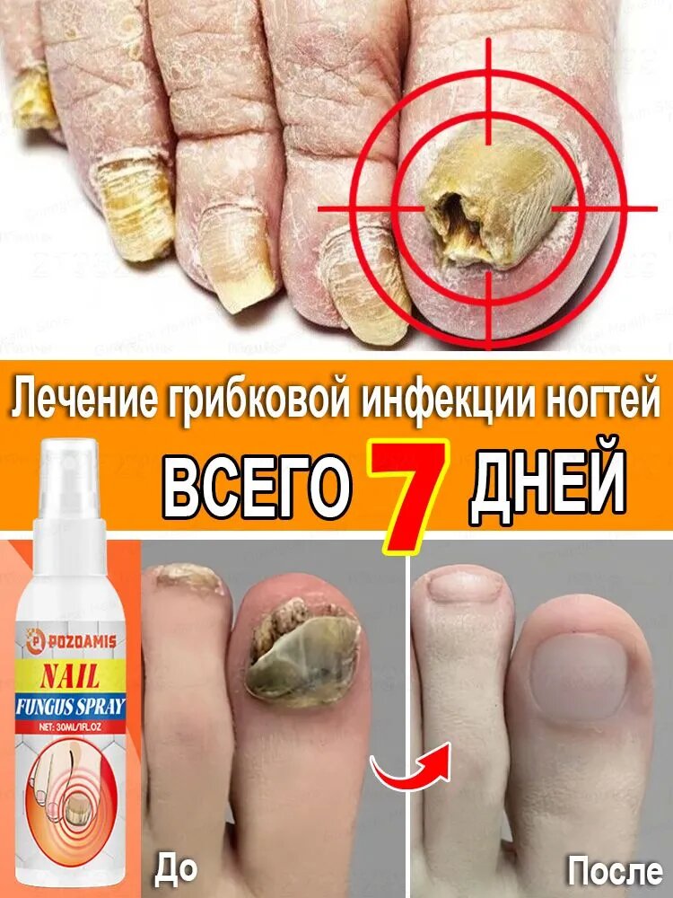 Используется для лечения грибка ногтей на ногах. Удаление грибковых инфекций, противогрибковые средства, Онихолизис , Ремонт ногтей.30 мл