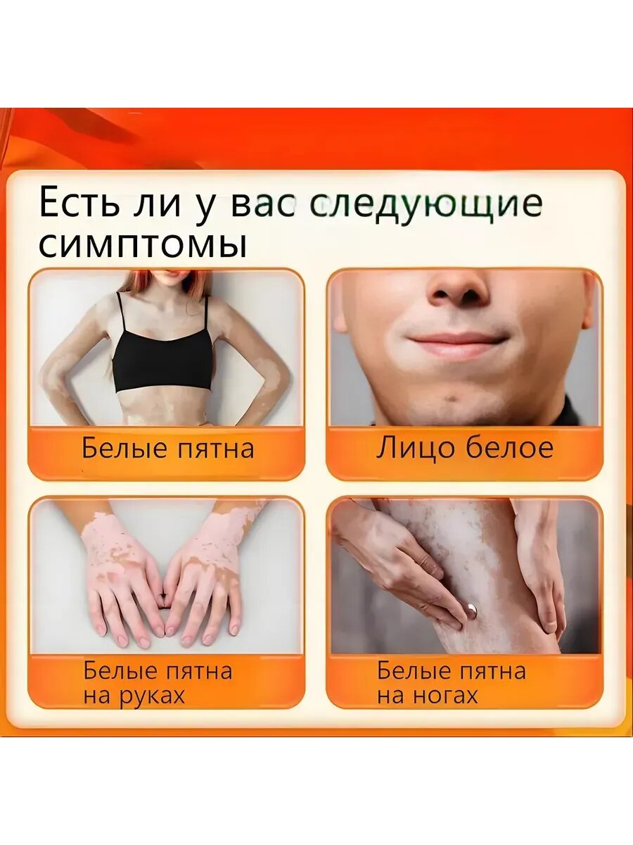 Крем от витилиго белых пятен кожи, 50 г