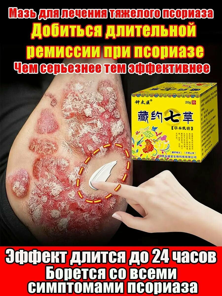 Мазь от псориаза, дерматита, шелушений и зуда для тела, лица, рук. Негормональное средство от прыщей, грибка и себорейного дерматита.
