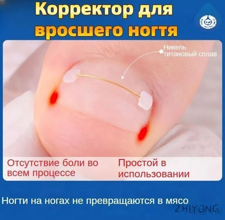 Комплект из 8 никелид-титановых корректоров для вросших ногтей