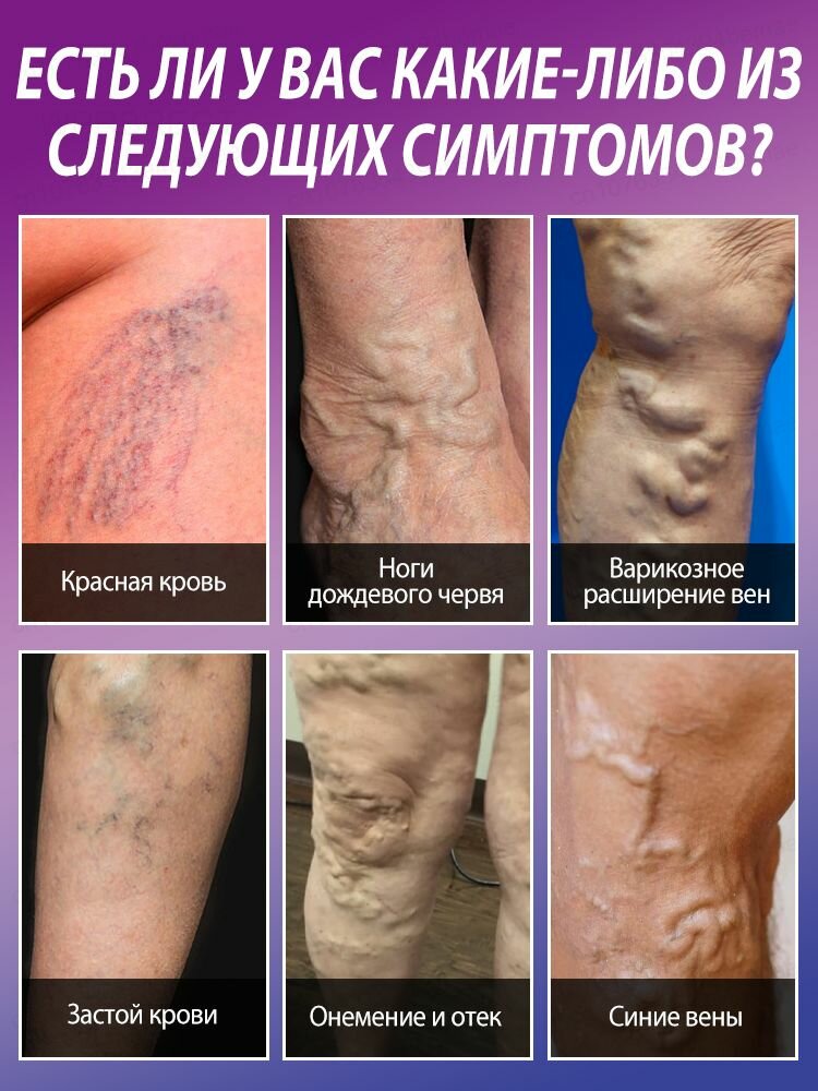 Варикозное расширение вен, лазерная указка, Эффективен при лечении варикозного расширения вен, сосудистых звездочек, тромбоза, усталости и опухших ног. 1 шт. для ног лазерное устройство