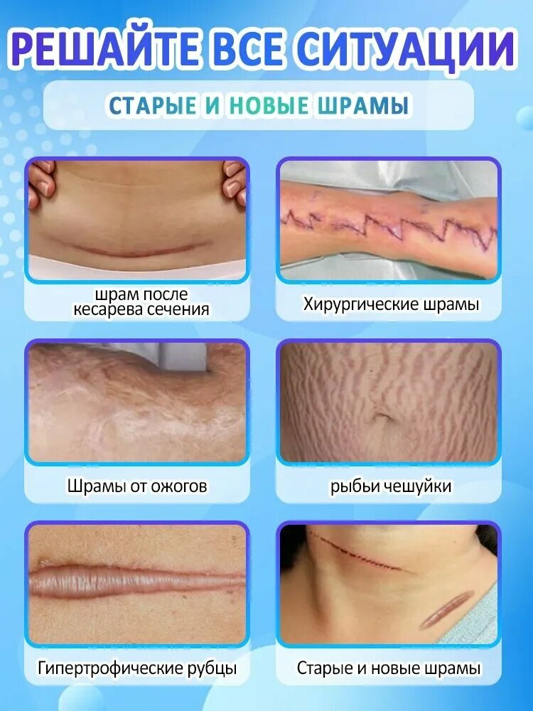 Крем от шрамов. Удаляют различные типы шрамов, ожоги от ножей, хирургические вмешательства, гиперплазию, приподнятые, впалые рубцы и растяжки. Восстанавливает и разглаживает кожу.10 упаковка.