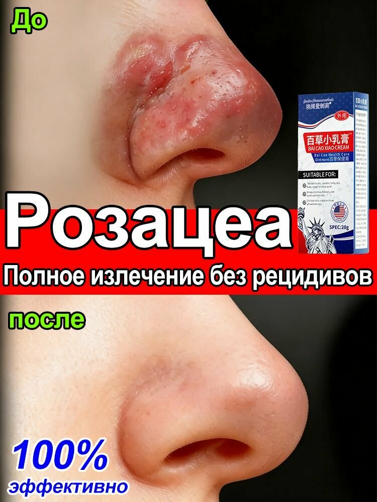 Мазь для лечения розацеа 20 г, уменьшает покраснение и припухлость носа, гиперемию и жирность кожи