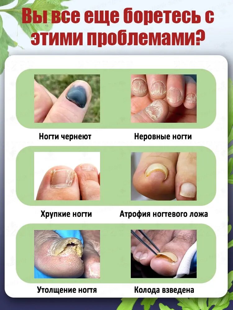 Пластыри от онихомикоза, быстрое устранение грибка ногтей на руках и ногах. Восстановление здоровых ногтей, против пожелтения и утолщения, снятие зуда, боли и воспаления, 21 шт.
