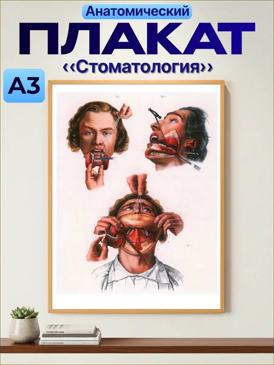 Постер медицинский, резекция нижней челюсти, стоматология, А3 эстетика анатомия, хирургия