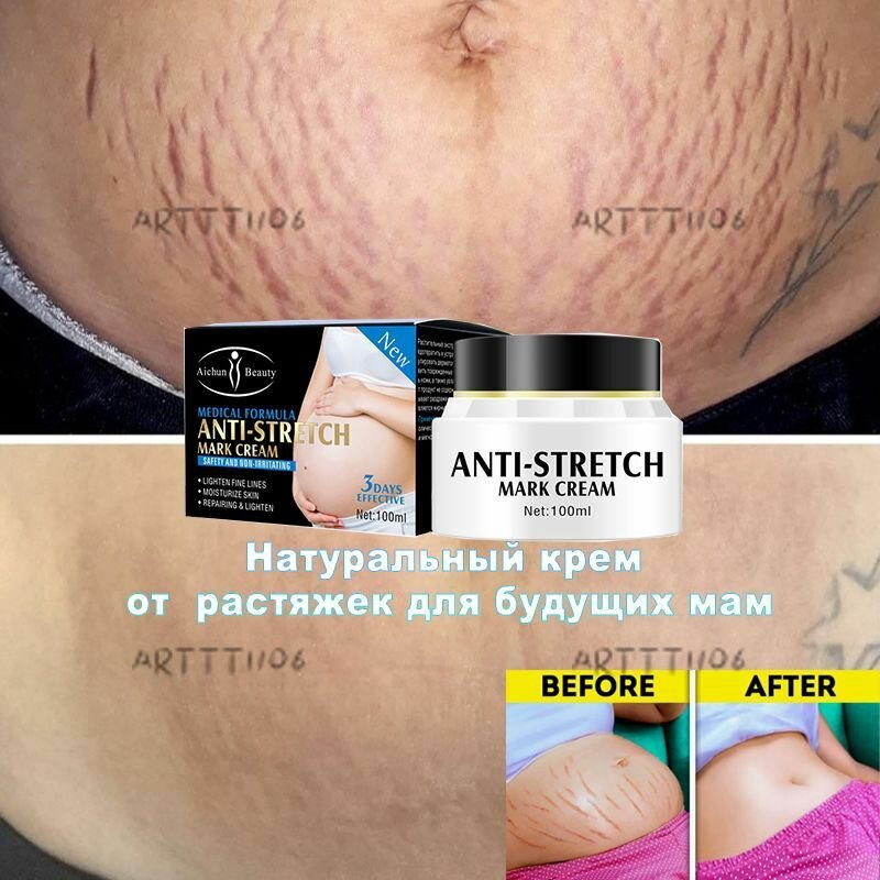 Крем от растяжек для беременных 100 грамм, используется при целлюлите и растяжках, подходит для ног и живота, восстанавливает и питает кожу. TnDZT