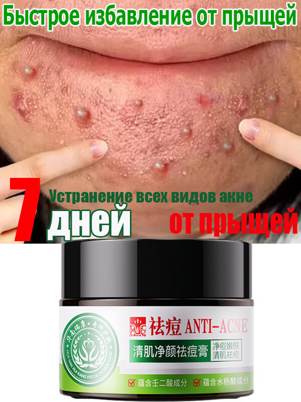 Крем для лица от акне прыщей воспалений 30г, от черных точек и угрей, жирной и чувствительной кожи, Подходит для лица