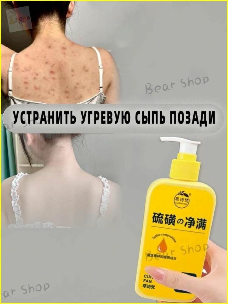 Гель для душа от прыщей, Стерилизация и удаление клещей, Глубоко очищает, Для мужчин, женщин и подростков,300 мл