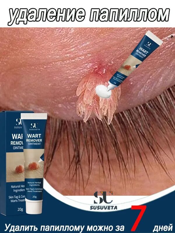 Для удаления бородавок папиллом, безболезненное удаление на лице и теле без шрамов и побочных эффектов