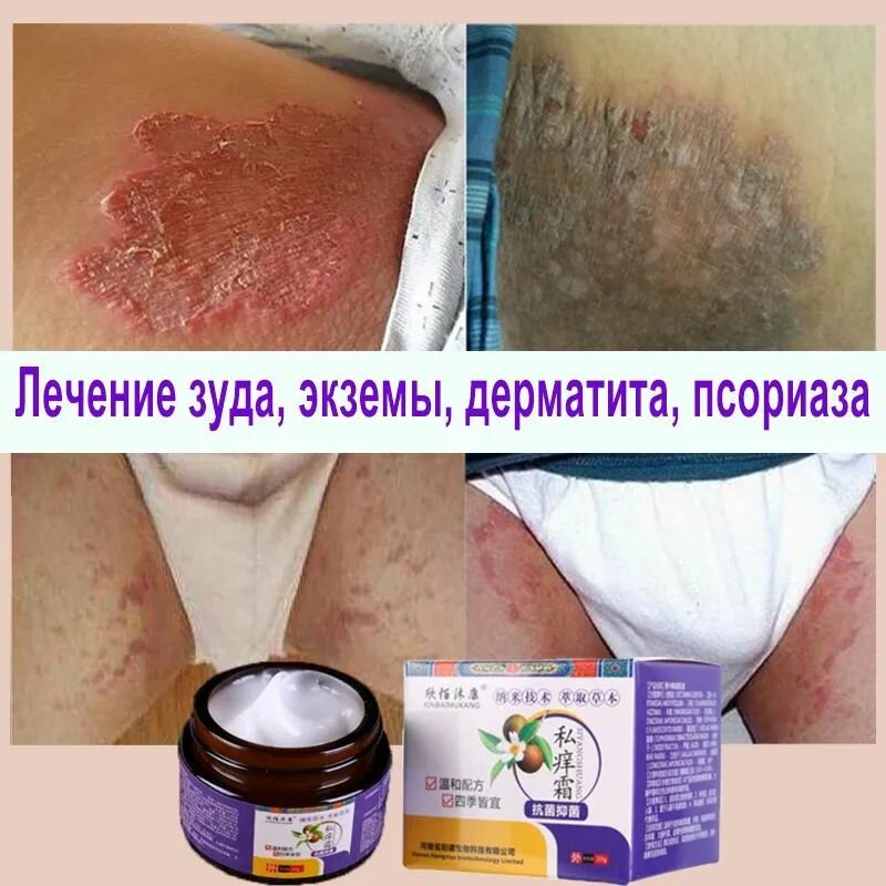 Успокаивающий крем-гель от зуда, воспаления и раздражения в интимных местах , Противозудная мазь , крем против зуда для интимных 30 г