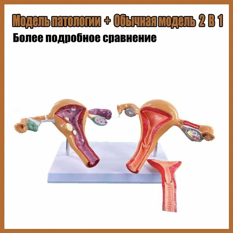 Норма + патология (комбинация) Макет "Органы матки, "Модели, структурная анатомия