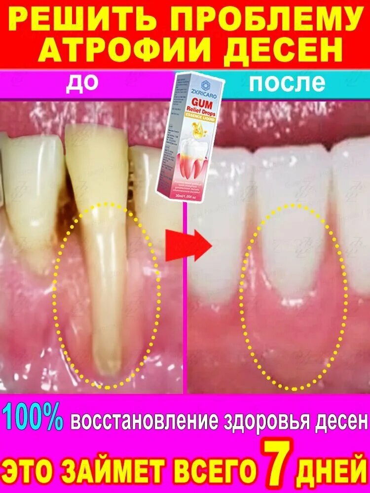 Используется для лечения пародонтита, стоматита, снятия чувствительности и отека десен, восстановления, профилактики и укрепления поврежденных десен, Гигиена полости рта.30 мл.