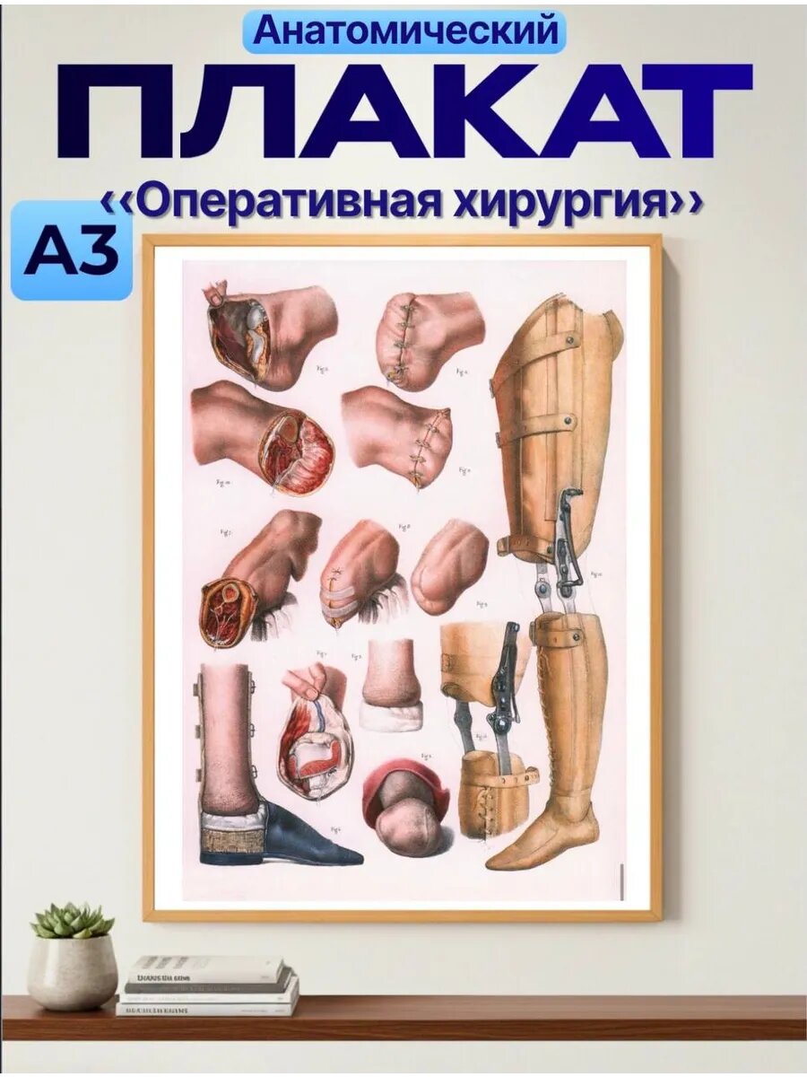 Постер медицинский, протезирование, оперативная хирургия, А3 анатомия, хирургия