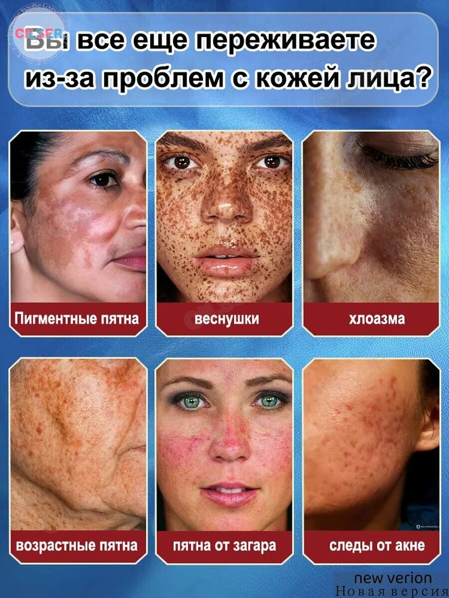 377 Отбеливающий крем от веснушек, пигментных пятен, 30 гр, эффективно борется со стойкими темными пятнами, осветляющий