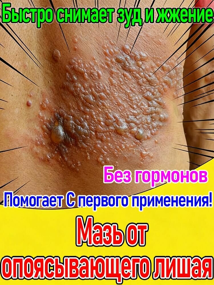 Мазь при опоясывающем герпесе