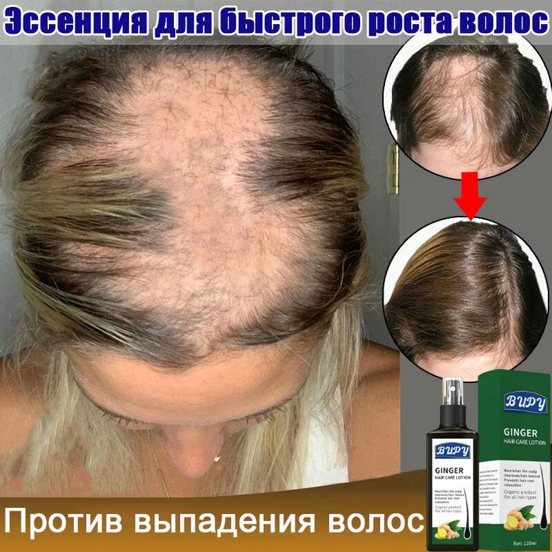 Спрей-сыворотка для роста волос 120мл, Средство от выпадения волос у женщин и мужчин, их роста и укрепления, увеличение густоты